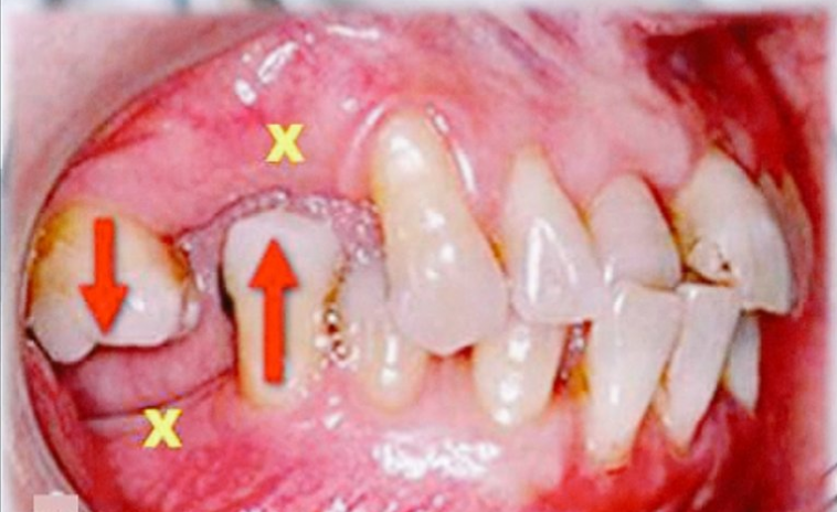 Tampal Sahaja Kalau Gigi Tu Berlubang, Dentist Ini Kongsikan 6 Kesan Masa Panjang Kalau Korang ...