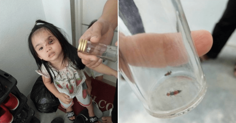 "Melecur kalau kena gigit" - Ini Cara Merawat Kesan Gigitan Semut ...