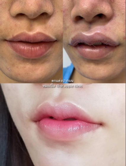 Mungkin Nampak Aneh, Tapi Trend Ini Dianggap Cantik Di Beberapa Negara ...