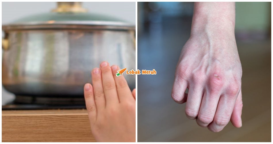 Kulit Melecur? Buat 5 Perkara Ini Untuk Elak Parut Kekal! - Lobak Merah