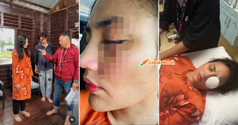 "Tulang mata kiri patah" - Fasha Sandha Masuk Hospital, Cedera Di Set Penggambaran - Lobak Merah