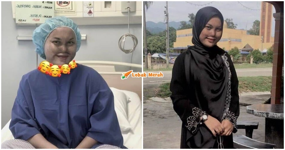 Terkena Percikan Asid Akibat Perselisihan Ibu Bapa, Wanita Tak Pernah ...